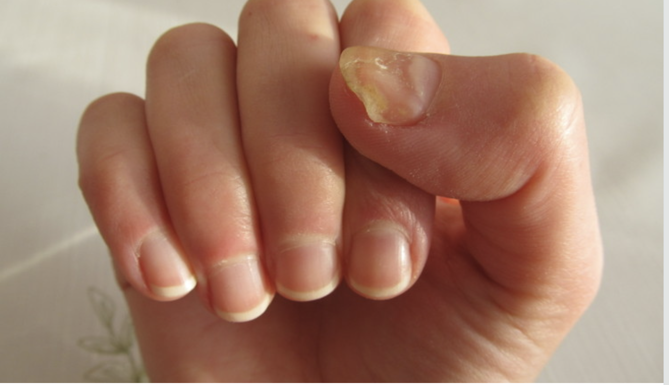 Treat Fungal Nail Infections Quickly and Effectively - MANCHESTER ...