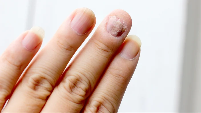 Effective Treatments for Fungal Nail Infections at My Dermatology ...