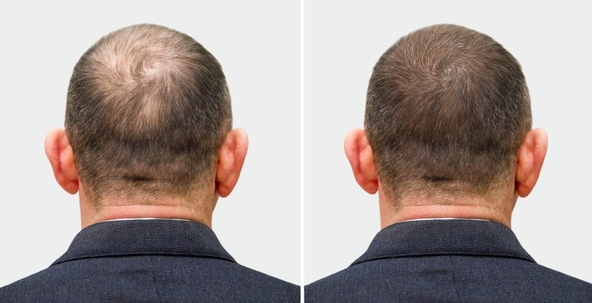 PRP (Platelet Rich Plasma) - MANCHESTER DERMATOLOGY CLINIC