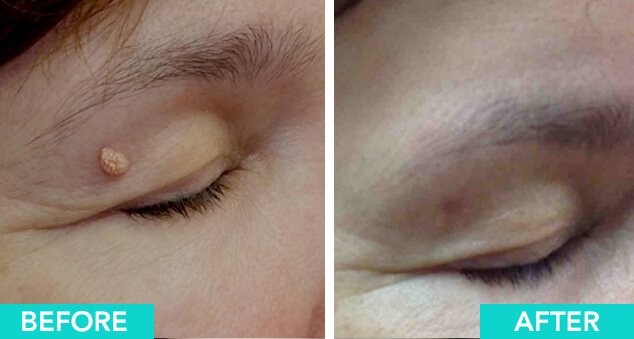 Wart Removal Methods - MANCHESTER DERMATOLOGY CLINIC